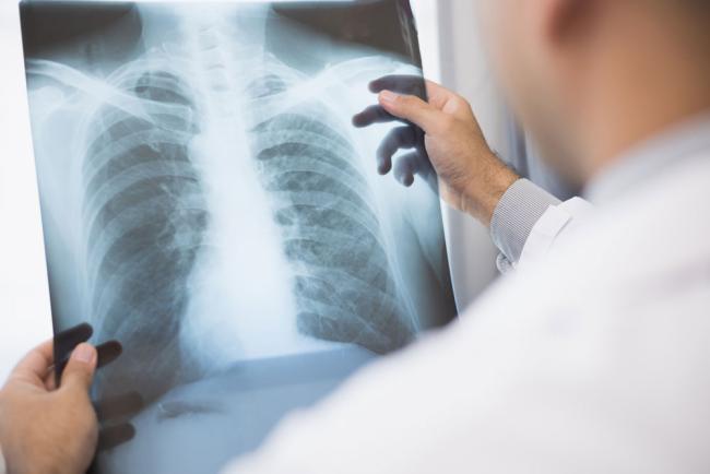 NHS launches AI and robot pilot to spot lung cancer | Government Technology